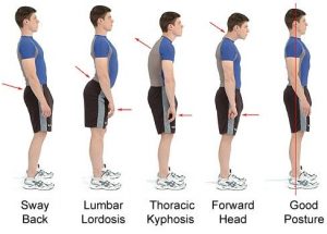 Posture And Postural Defects - ClassNotes.ng
