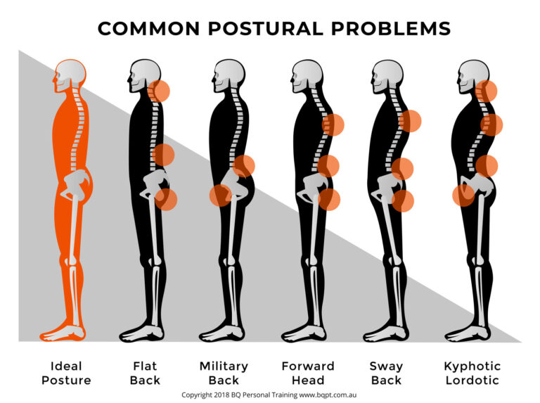 Types of Postural Defects - Class Notes