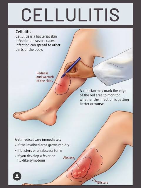 Boils, Cellulitis, Necrotizing Fasciitis - ClassNotes.ng